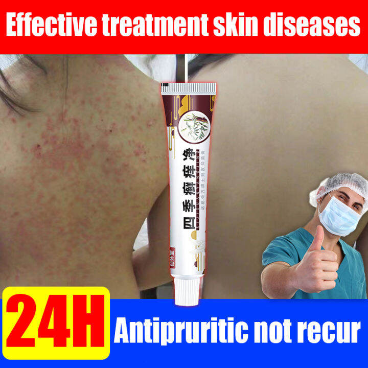 Ringworm Removal Ointment Psoriasis Ointment Eczema Treatment Cream ...
