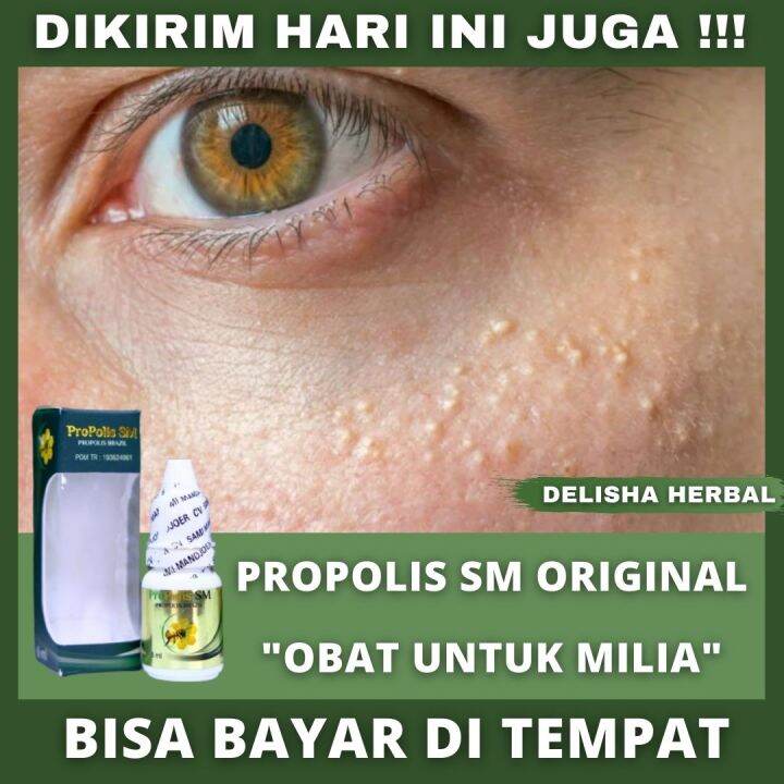 Solusi Obat Tetes Milia Di Bawah Mata, Penghilang Bintik Milea ...