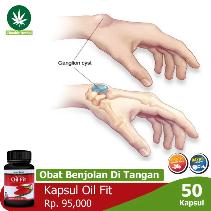 Obat Benjolan Di Tangan Kista Ganglion Benjolan Di Pergelangan Tangan ...