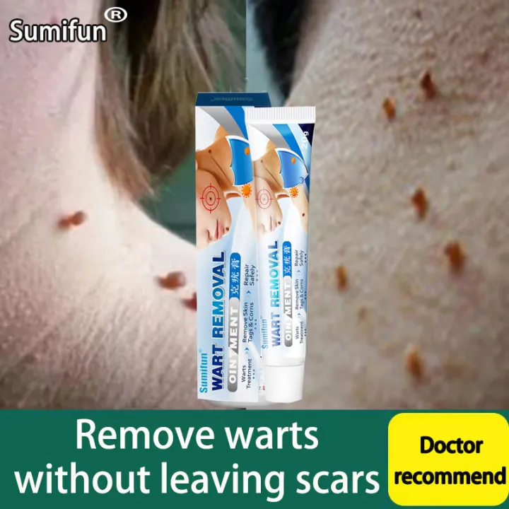 Sumifun wart remover cream 20g Effective and painless removal of common ...
