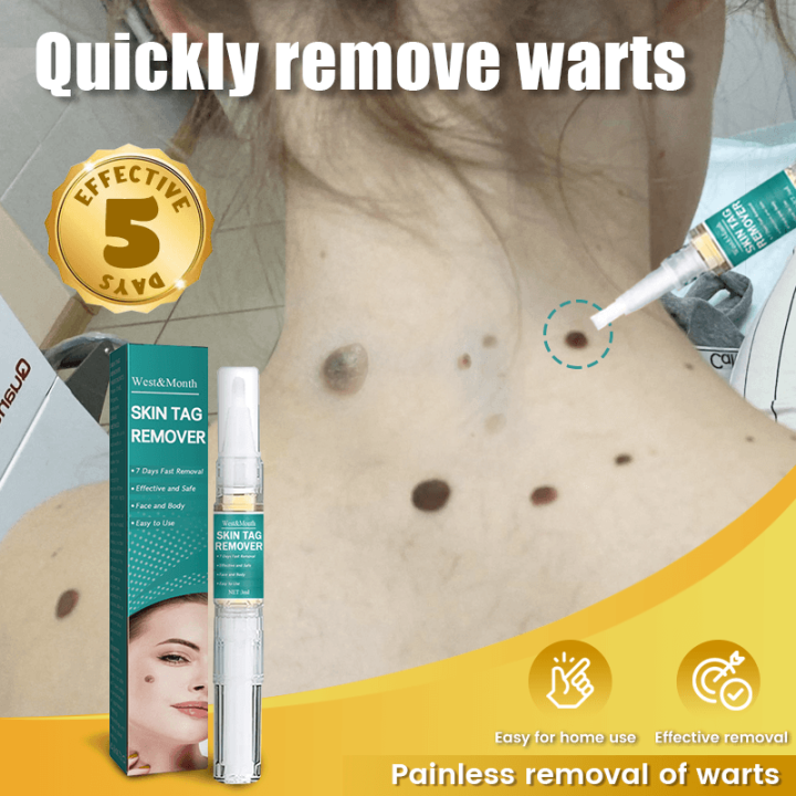 warts remover original removal cream watson kasoy oil mole and warts ...