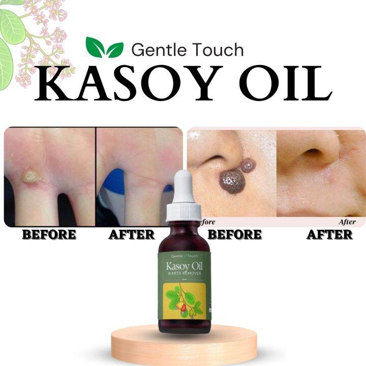 [Gentle Touch] 100% Original and Effective Kasoy Oil for Warts(Kulogo ...