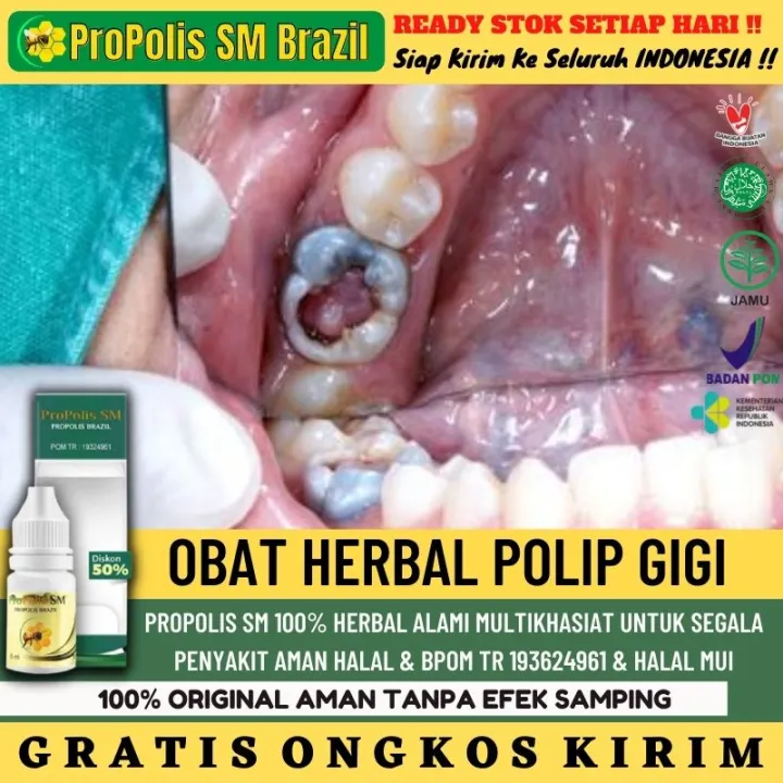 Obat Polip Gigi, Polip Gusi, Gusi Bengkak, Obat Polip Pulpa Gigi, Gusi ...