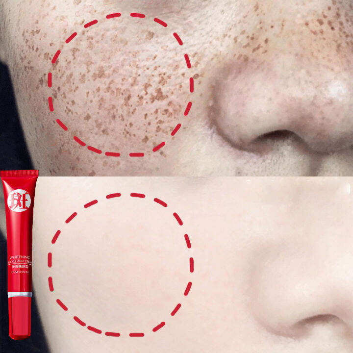 (Remove freckles quickly in 7 days) freckle cream, effective freckle ...
