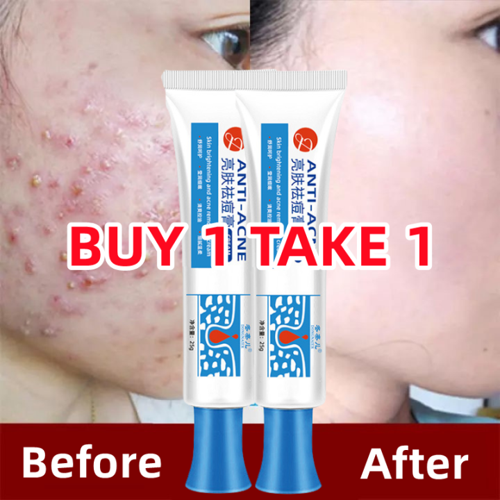【BUY 1 TAKE 1】100% Effective Remove Pimples Quickly Pimple Remover Acne Cream Fades Acne Marks ...