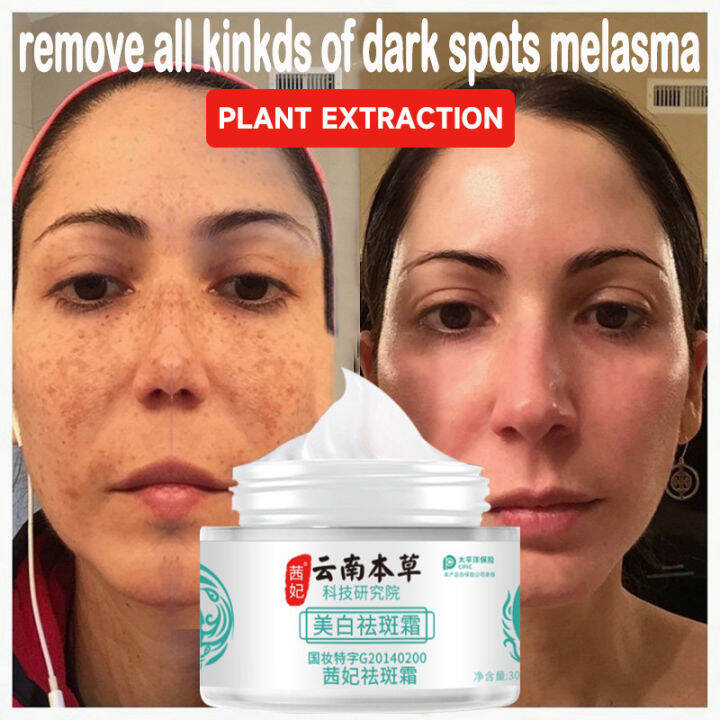 Melasma Cream Yunnan Herbal Whitening Freckle Cream Japanese Melasma ...
