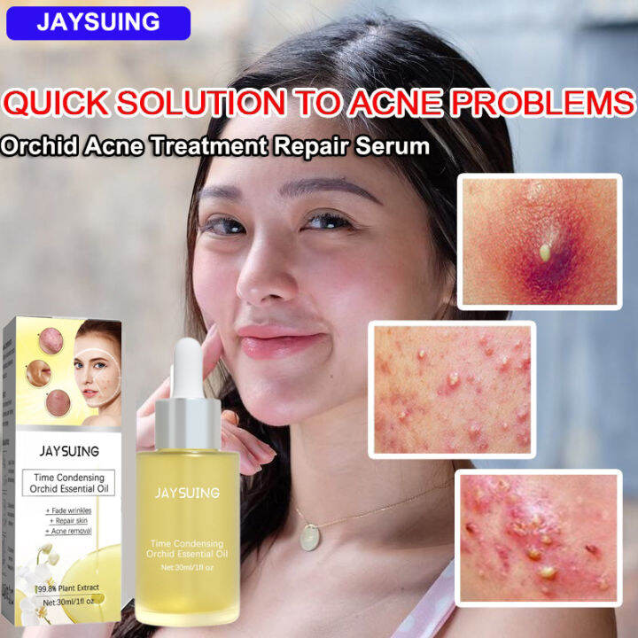 Jaysuing Orchid Acne Treatment Serum Fixscar Anti Acne Scar Removal