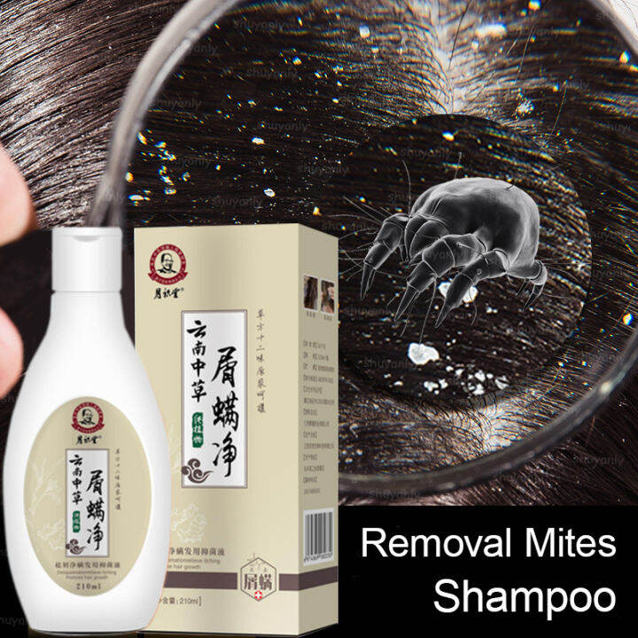 Herbal Dandruff Remover Shampoo Anti Dandruff Scalp Treatment Removal ...