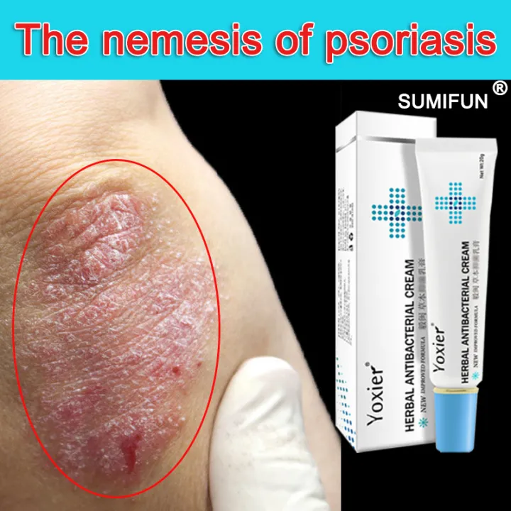 Doctor Recommended Yoxier Psoriasis Ointment Solution for Psoriasis ...