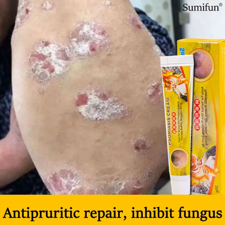 Ready to send Sumifun natural herbal cream Cream to relieve itching ...