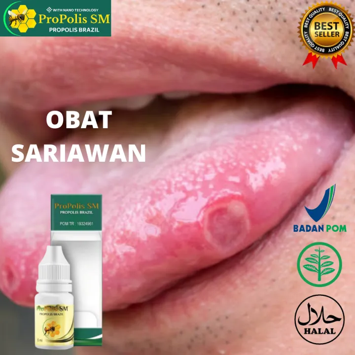Obat Herbal mengatasi sariawan dan Panas Dalam, Obat Sariawan, Obat ...