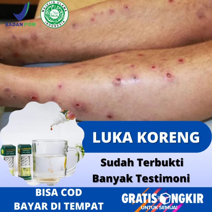 Obat Luka Koreng Bernanah, Herbal Mengeringkan Koreng Basah Berair ...