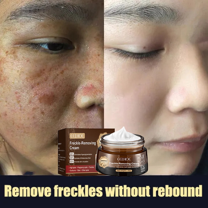 7 Days pigmentation removal cream 30g(black spot face melasma removal ...