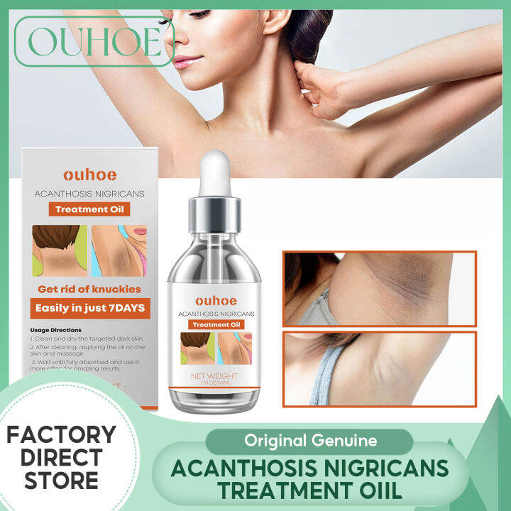 Ouhoe Acanthosis Nigricans Treatment Oil Repair Armpit Elbow Knee Joints Thigh Inner Whitening ...