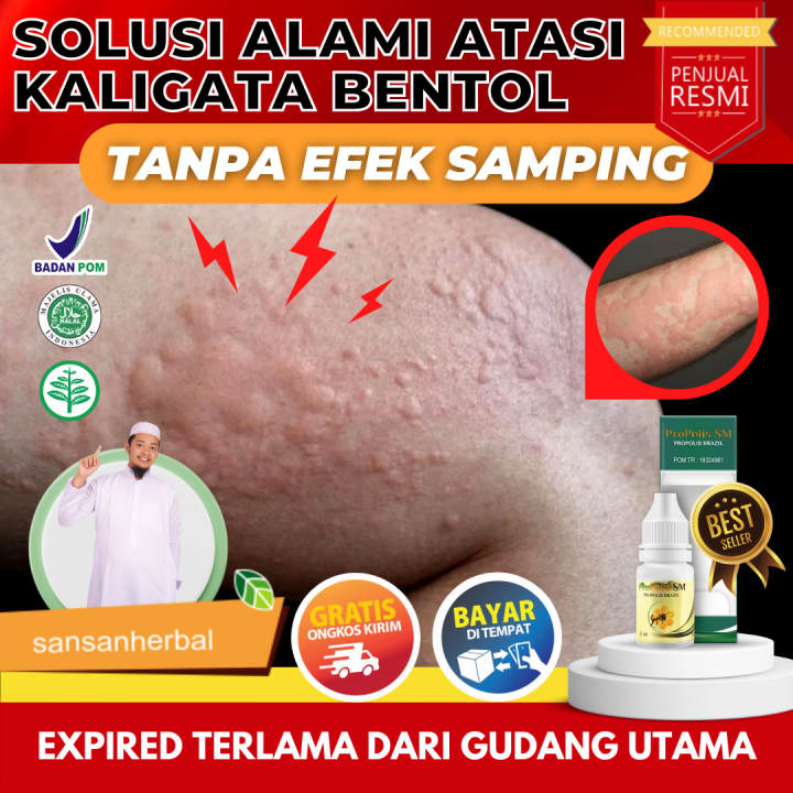 Obat Kaligata Bentol Bentol, Obat Bentol Dan Kaligata, Obat Gatal ...