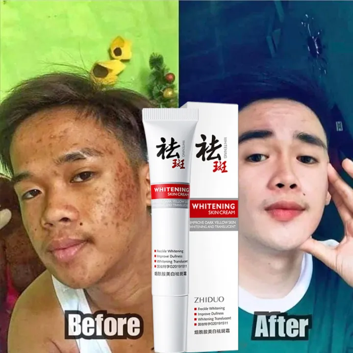 Genuine Whitening Freckle Cream freckle removal whitening cream melasma ...