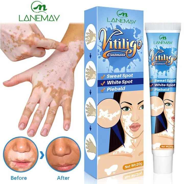 Topical cream for sweat spots and white spots and florid skin Spot Care ...