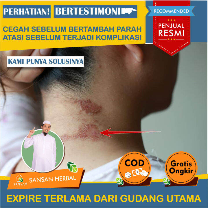 Obat Gigitan Tomcat, Obat Kena Tomcat, Obat Di Gigit Serangga Tomcat ...