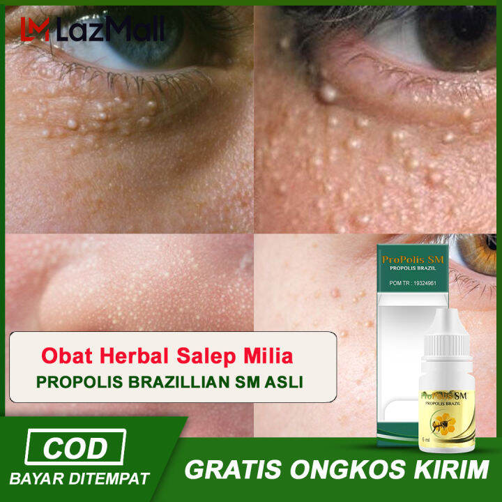 Propolis SM Brazil Asli 100% Original Obat Milia, Penghilang Milia ...