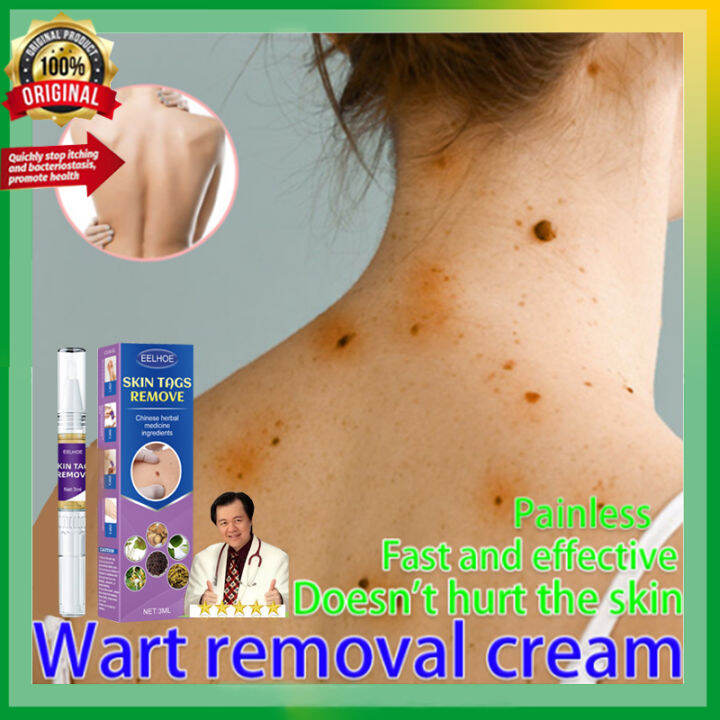 warts remover original removal cream watson kasoy oil mole and warts ...