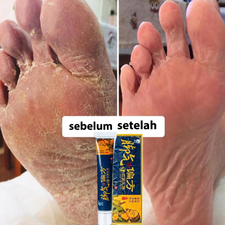 salep tinea pedis salep kaki kaki gatal salep kaki gatal menghilangkan ...
