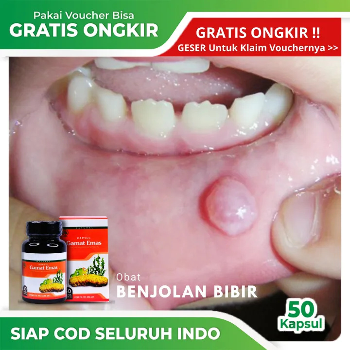 Obat Mucocele, Benjolan Di Bibir, Benjolan Bibir Bagian Dalam, Mukokel ...