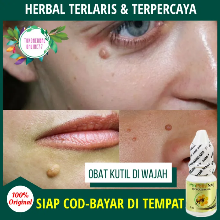 OBAT KUTIL DI WAJAH Propolis Brazil SM Original - Solusi Penghilang ...