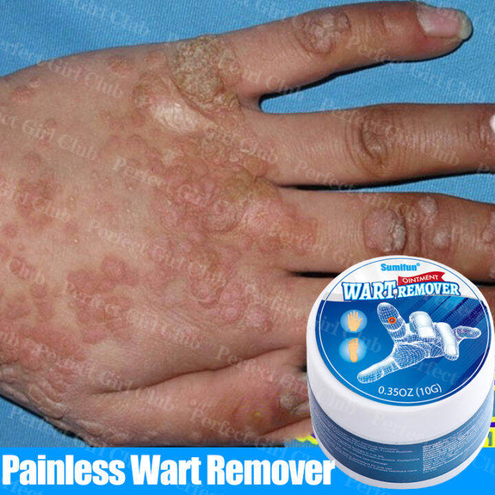 7 days Effective! Sumifun Wart Remover Cream Warts Magic Remover Wartz ...