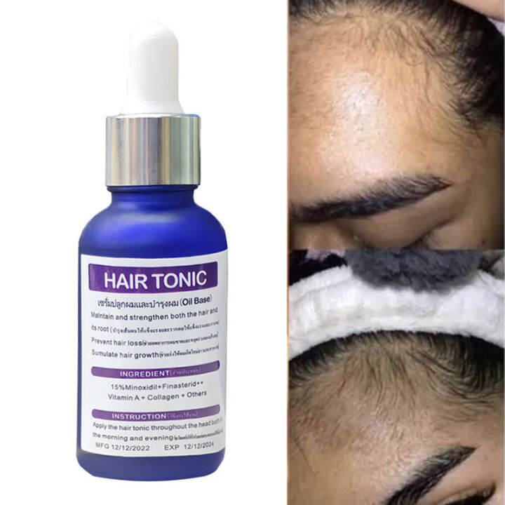 MINOXIDIL HAIR TONIC THAILAND OIL BASE 15% 30ml | Lazada PH