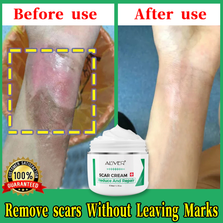 ALIVER Scar Cream Effectively Remove Stretch Marks, Acne and Burns Skin ... ALIVER Scar Cream Effectively Remove Stretch Marks, Acne and Burns Skin ...