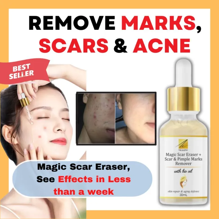 Niceahh Magic Scar Eraser | Scar & Pimple Marks Remover | pantanggal ...