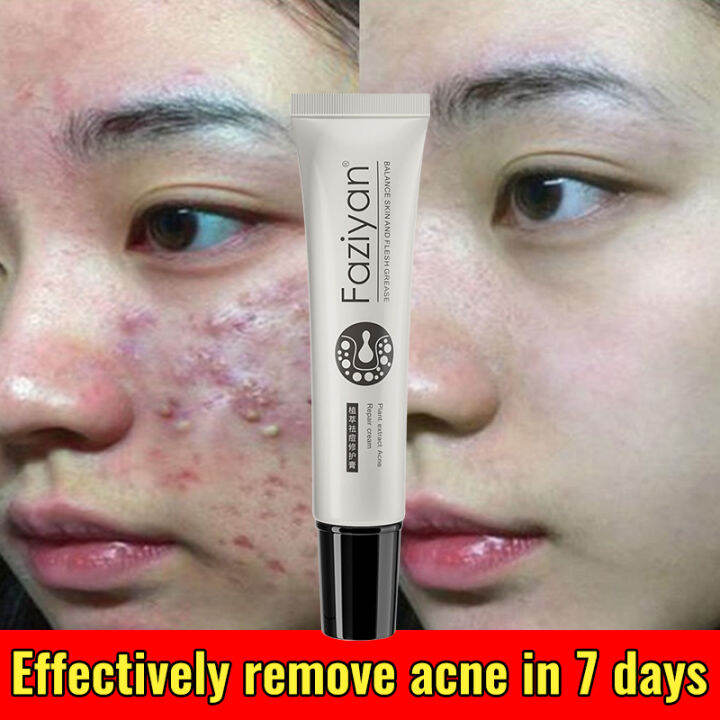 Original 100% Effective Acne Cream Acne Scar Remover Pimple Remover Skin Care Anti Acne ...