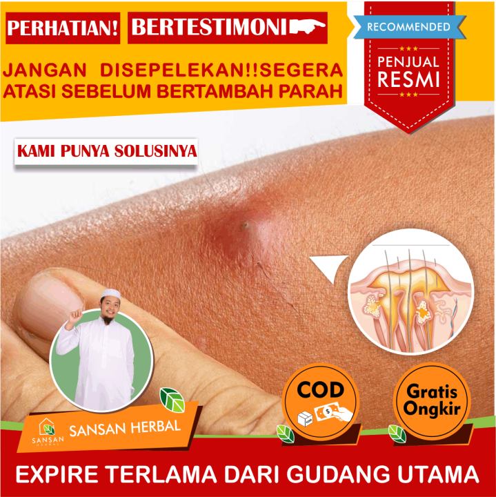 Salep Bisulan, Salep Untuk Penyakit Bisulan, Salep Untuk Bisulan, Salep ...