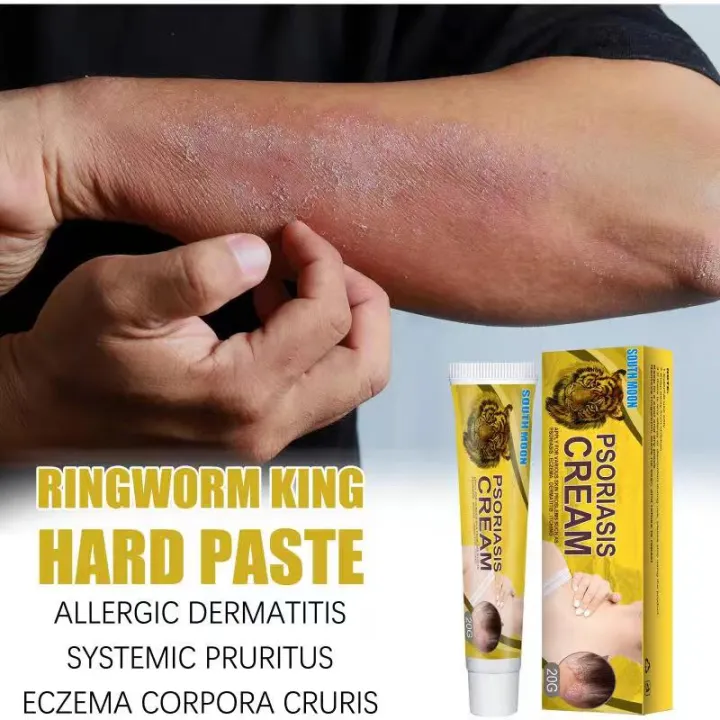EELHOE PSORIASIS CREAM FOR ECZEMA,DERMATITIS,ITCHING | Lazada PH
