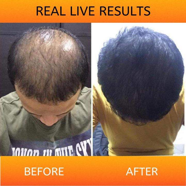RAMBUT TUMBUH BARU FIBRE | Lazada